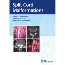 Split Cord Malformations - Ashok Mahapatra, Sachin Borkar, Subhashree Mahapatra, Gebunden