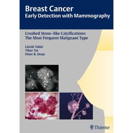 Early Detection with Mammography - Laszlo Tabar, Tibor Tot, Peter B. Dean, Gebunden